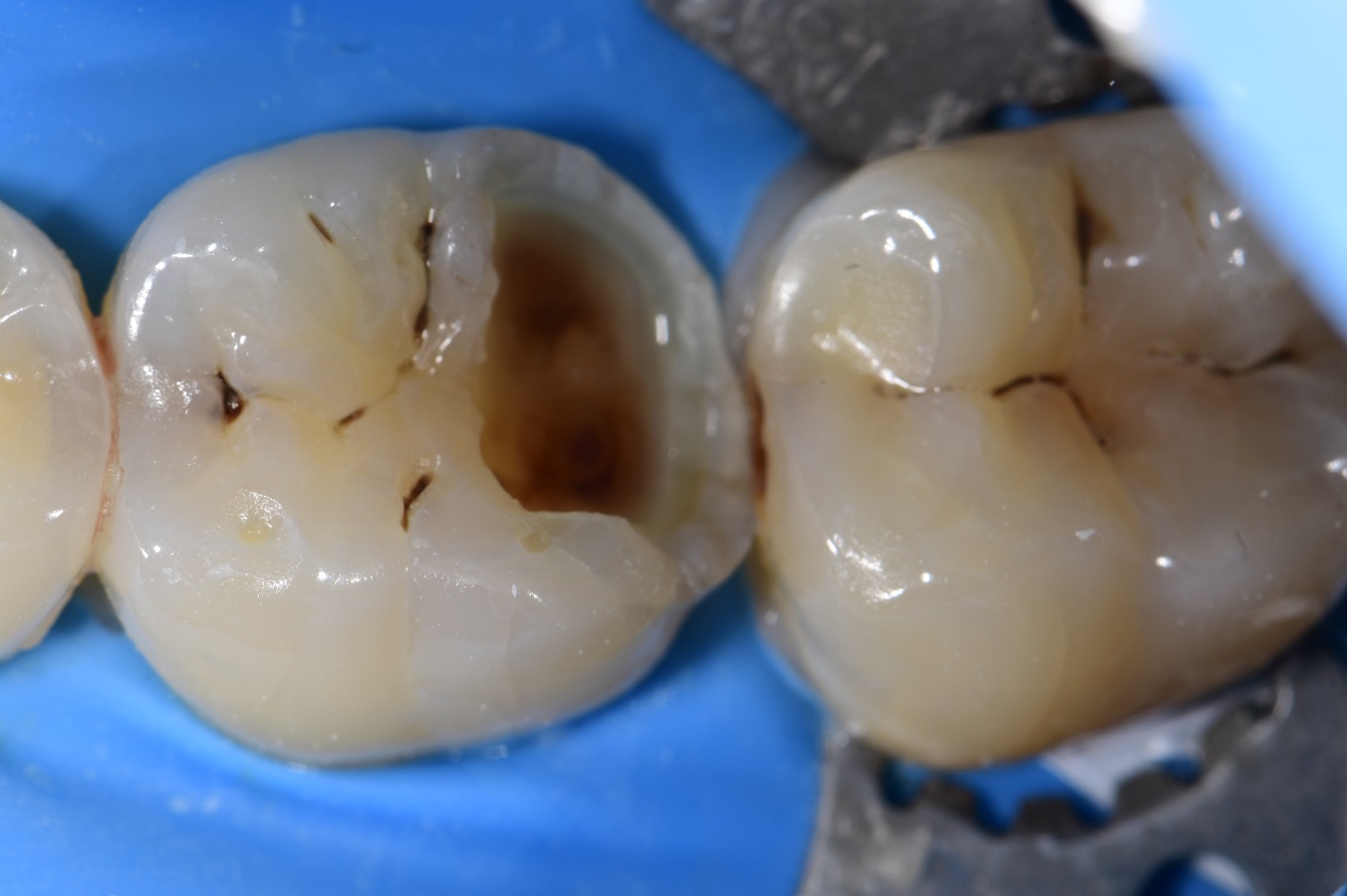 Traumatic Fracture of Tooth from Heavy Bite