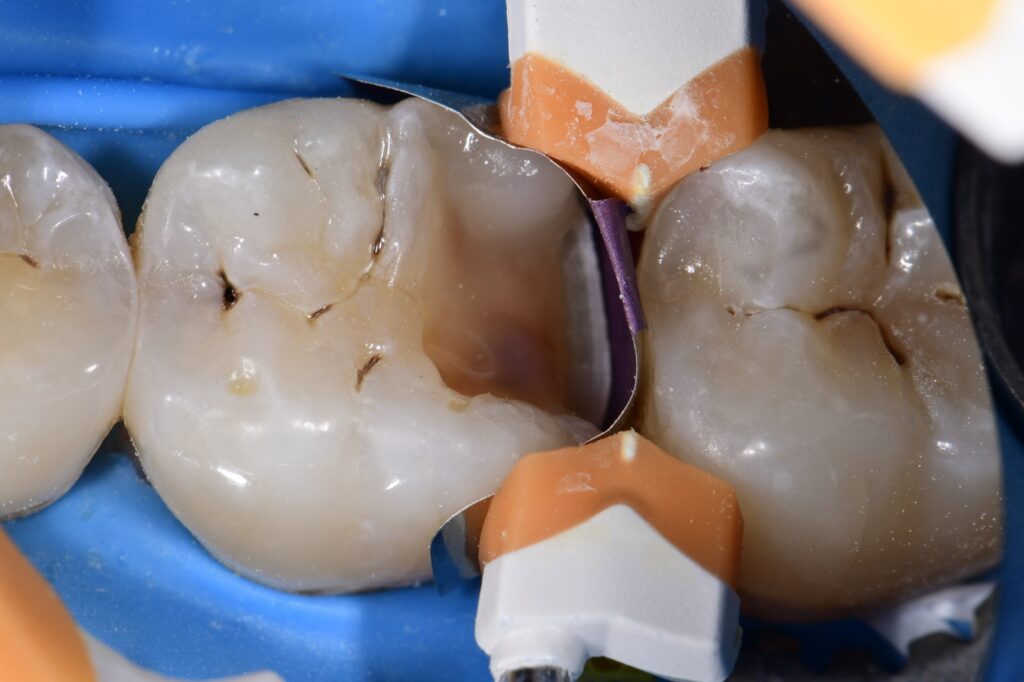 Traumatic Fracture of Tooth from Heavy Bite