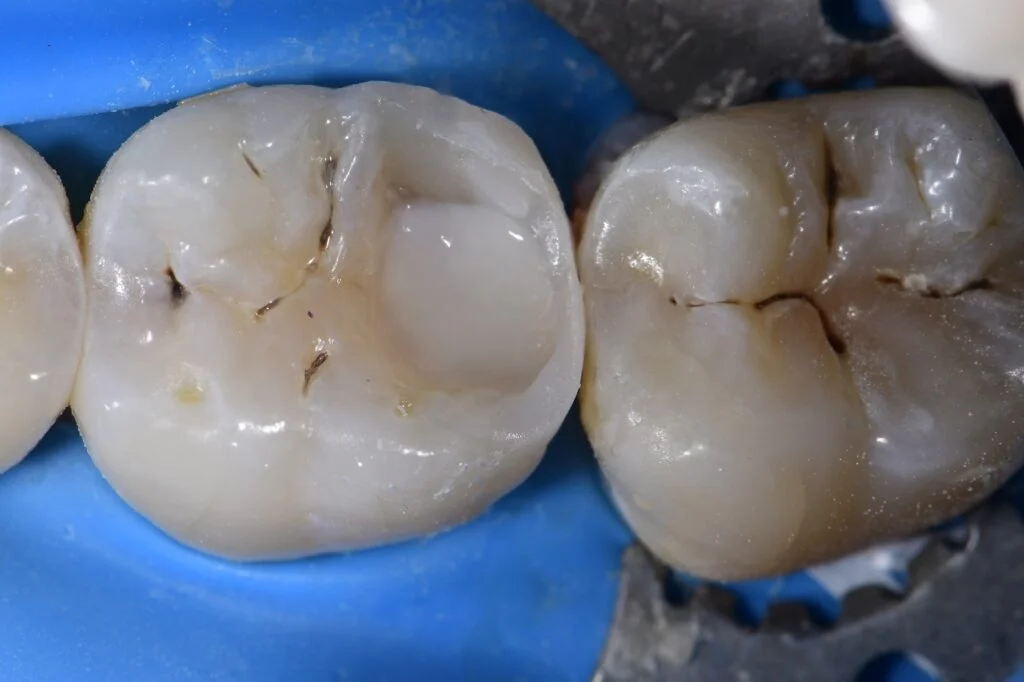 Traumatic Fracture of Tooth from Heavy Bite
