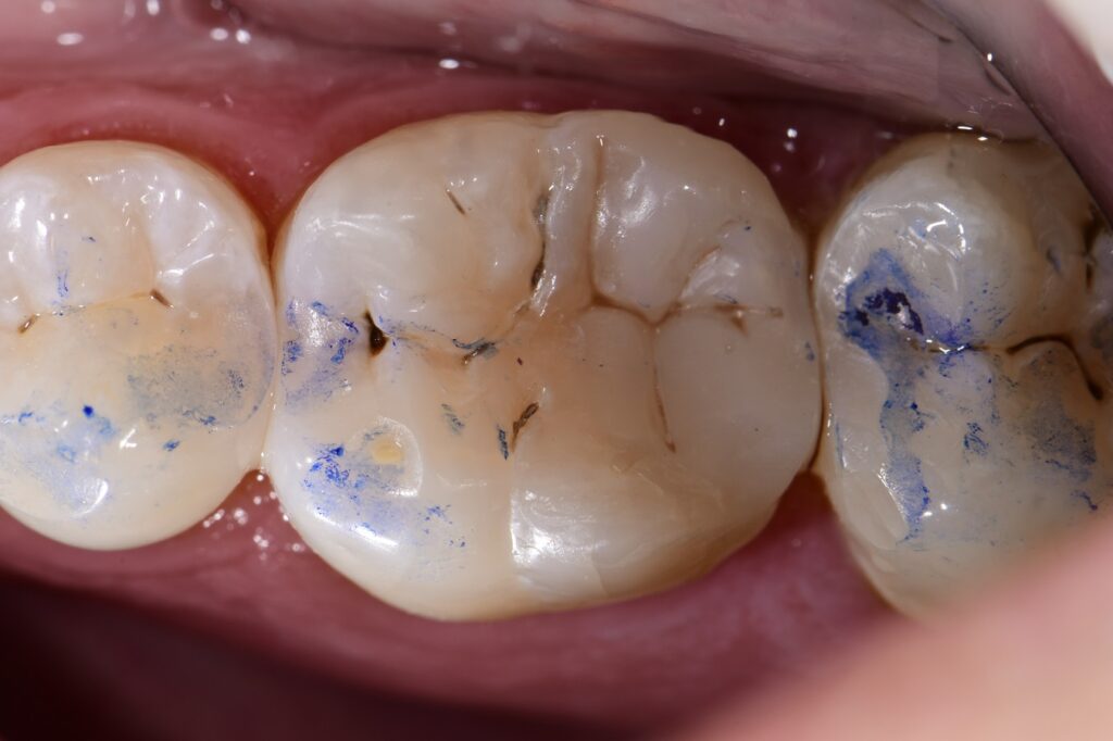 Traumatic Fracture of Tooth from Heavy Bite