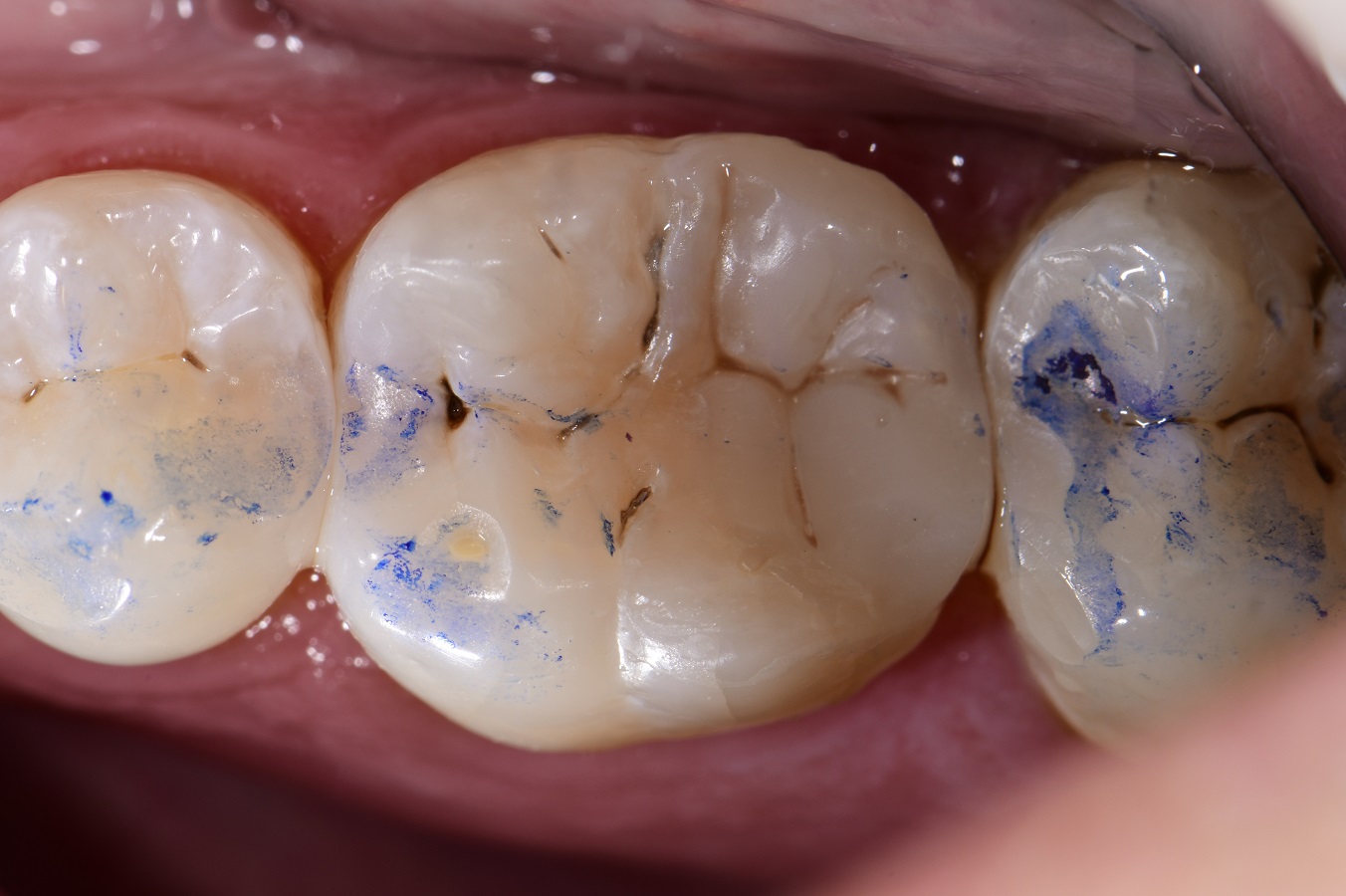 Traumatic Fracture of Tooth from Heavy Bite