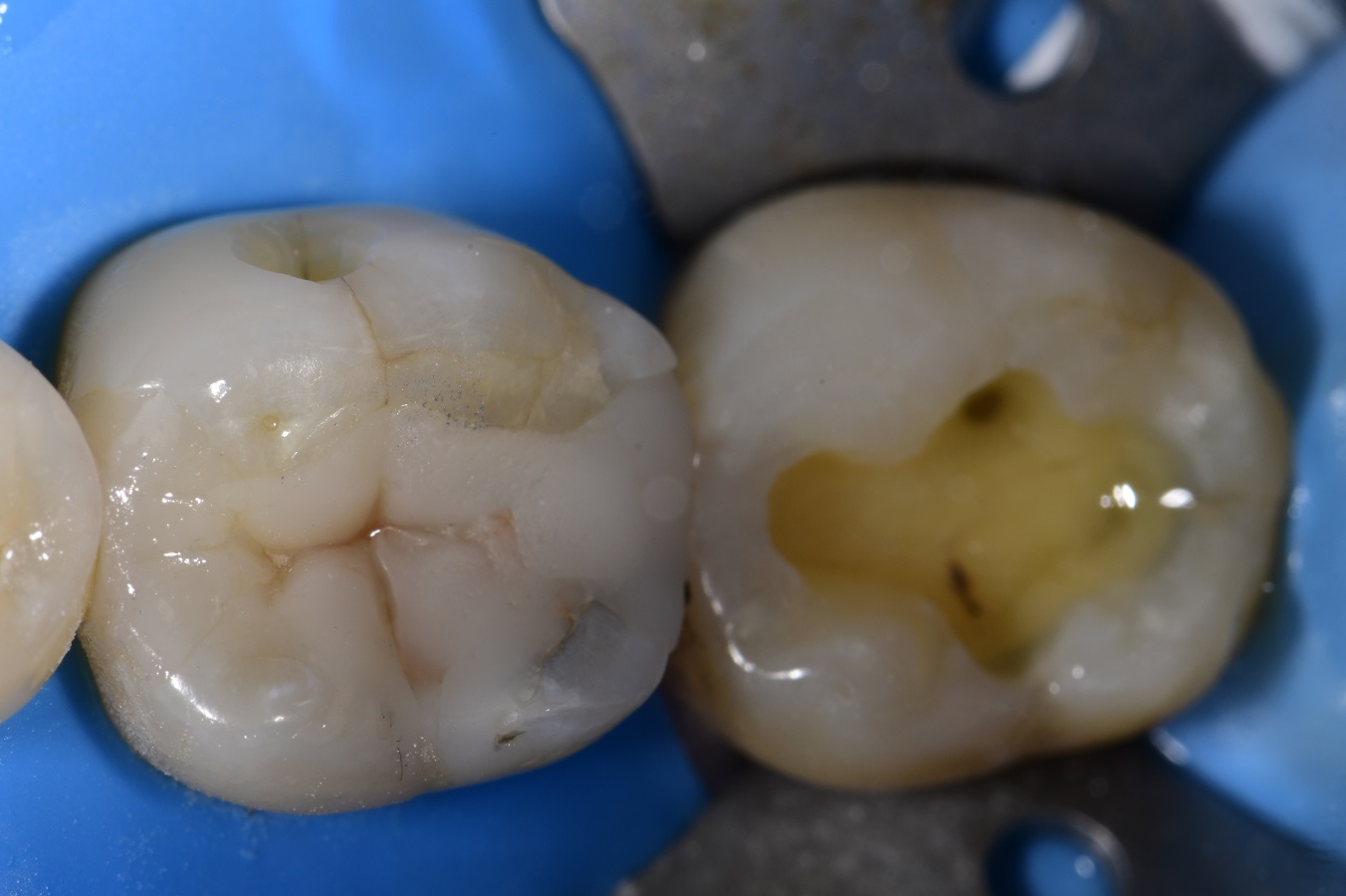 Dental Amalgam Replacement