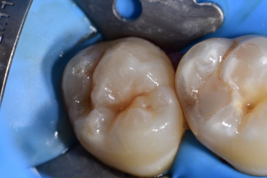 Conservative Restorations Conservative Restorations