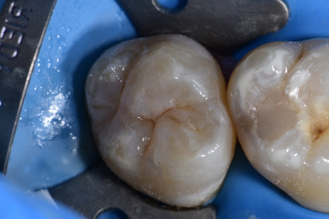 Conservative Restorations Conservative Restorations