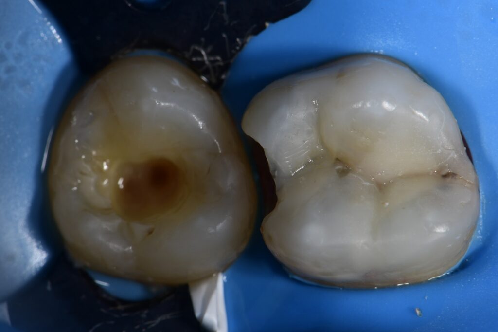 Creating Invisible Fillings Creating Invisible Fillings