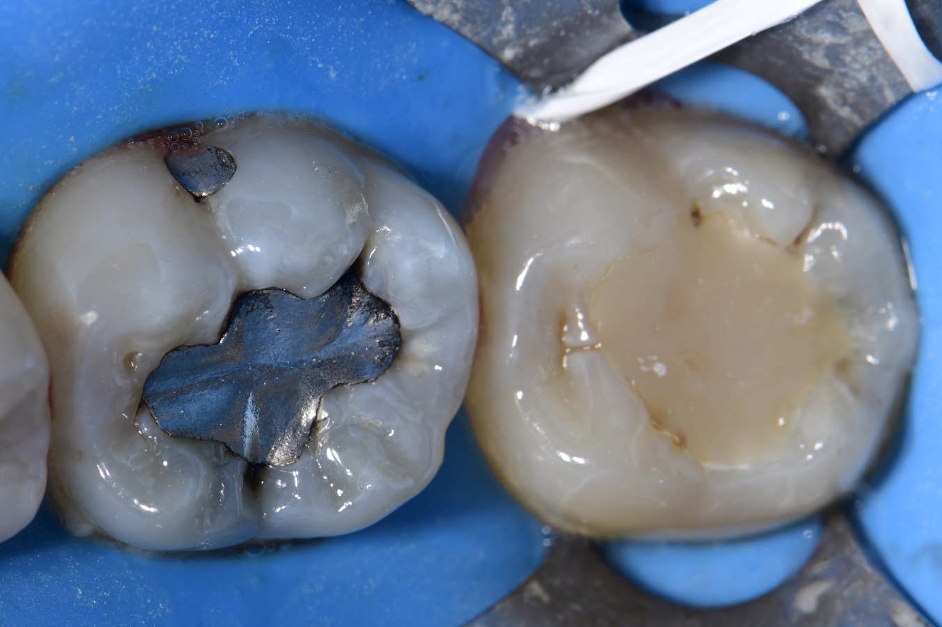 Replacing Amalgams and Blocking Dark Stain Class I anatomy
