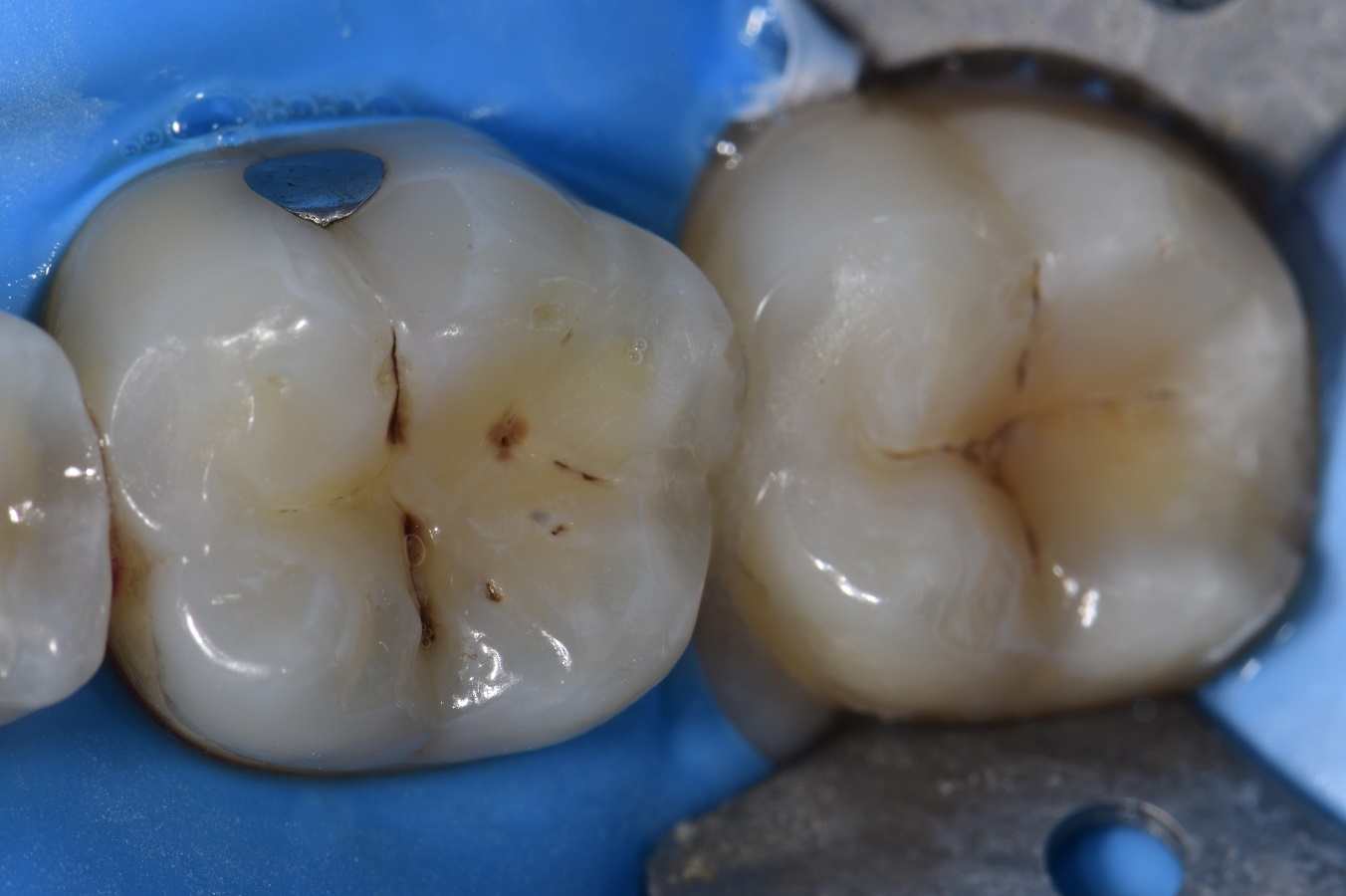 Microsculpting composite resin for dental fillings