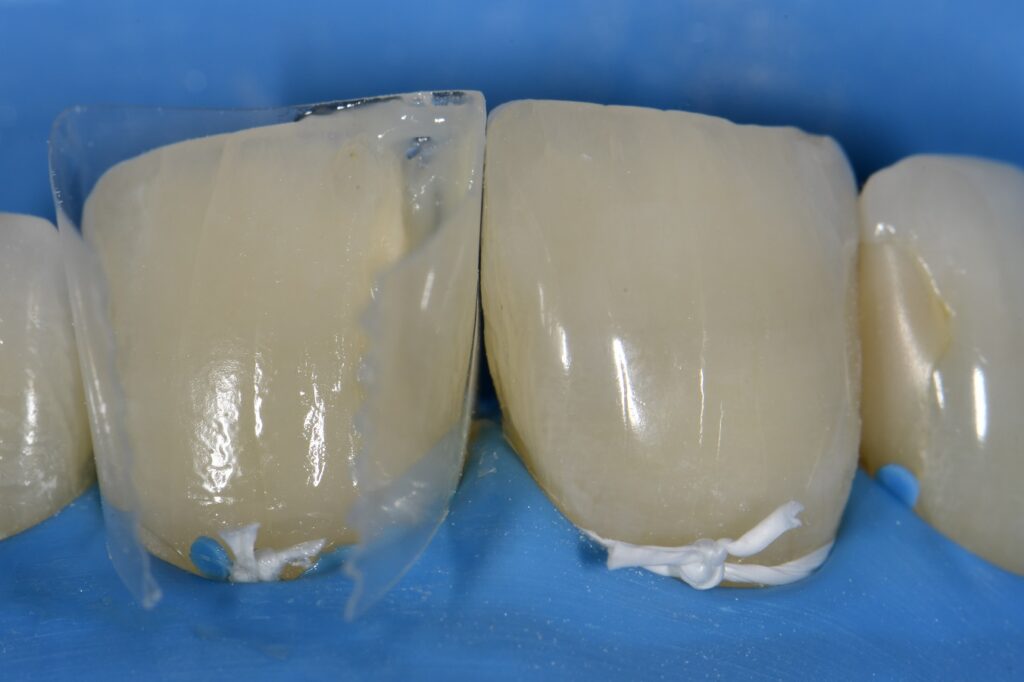 Anterior Composite Esthetics Anterior Composite Esthetics