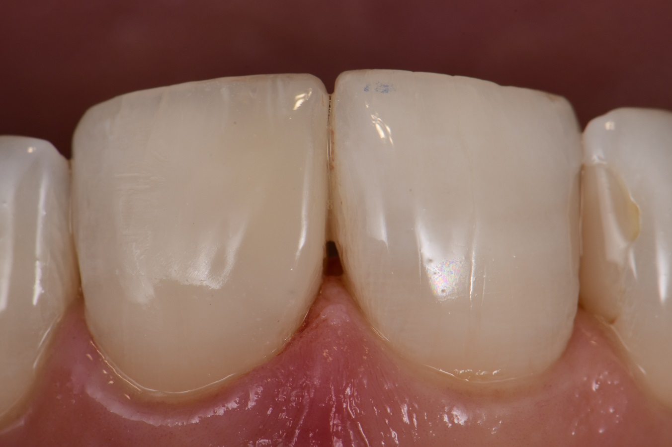 Anterior Composite Esthetics Anterior Composite Esthetics