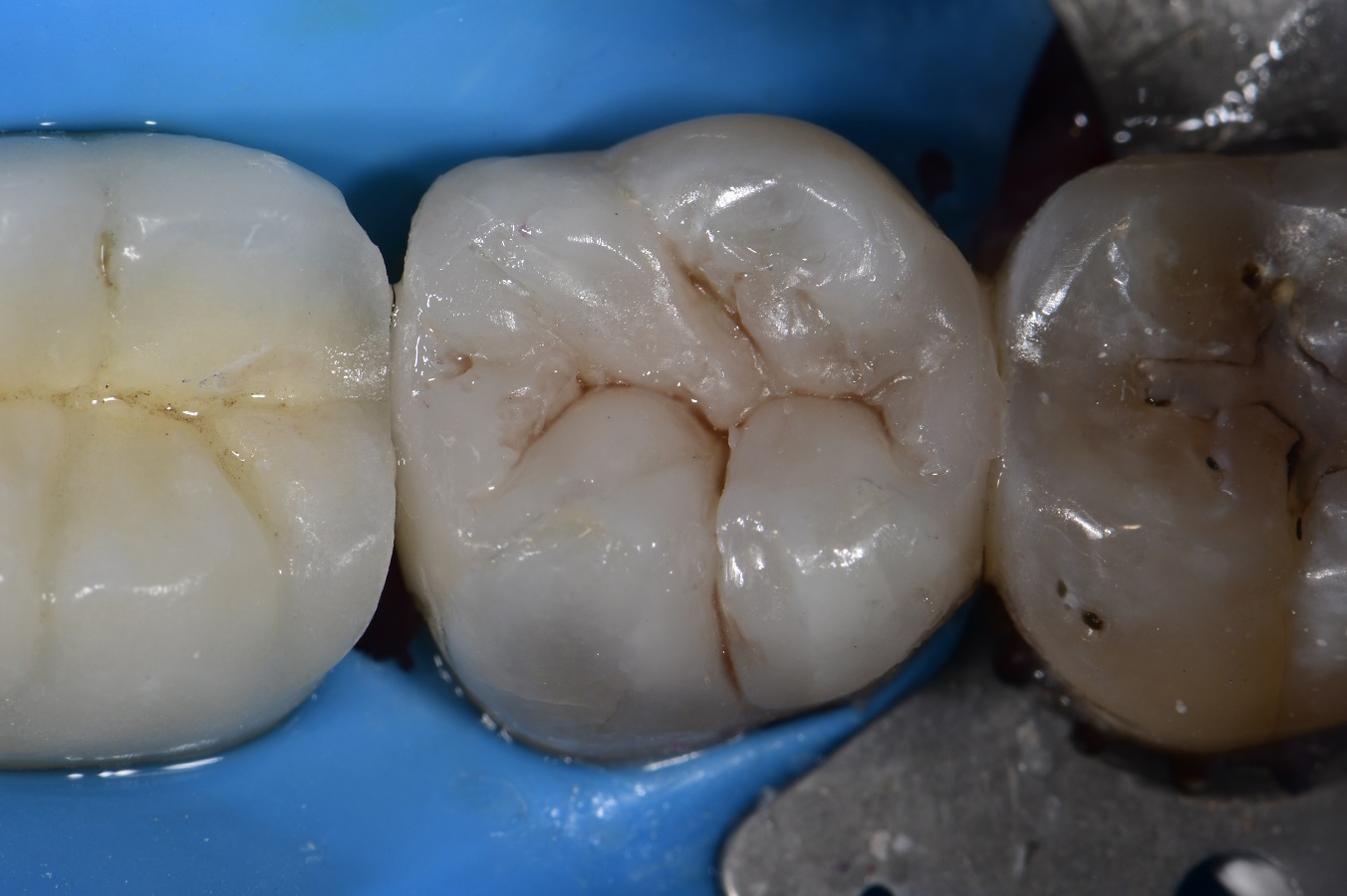 Extensive Composite Restorations to Avoid Crowns