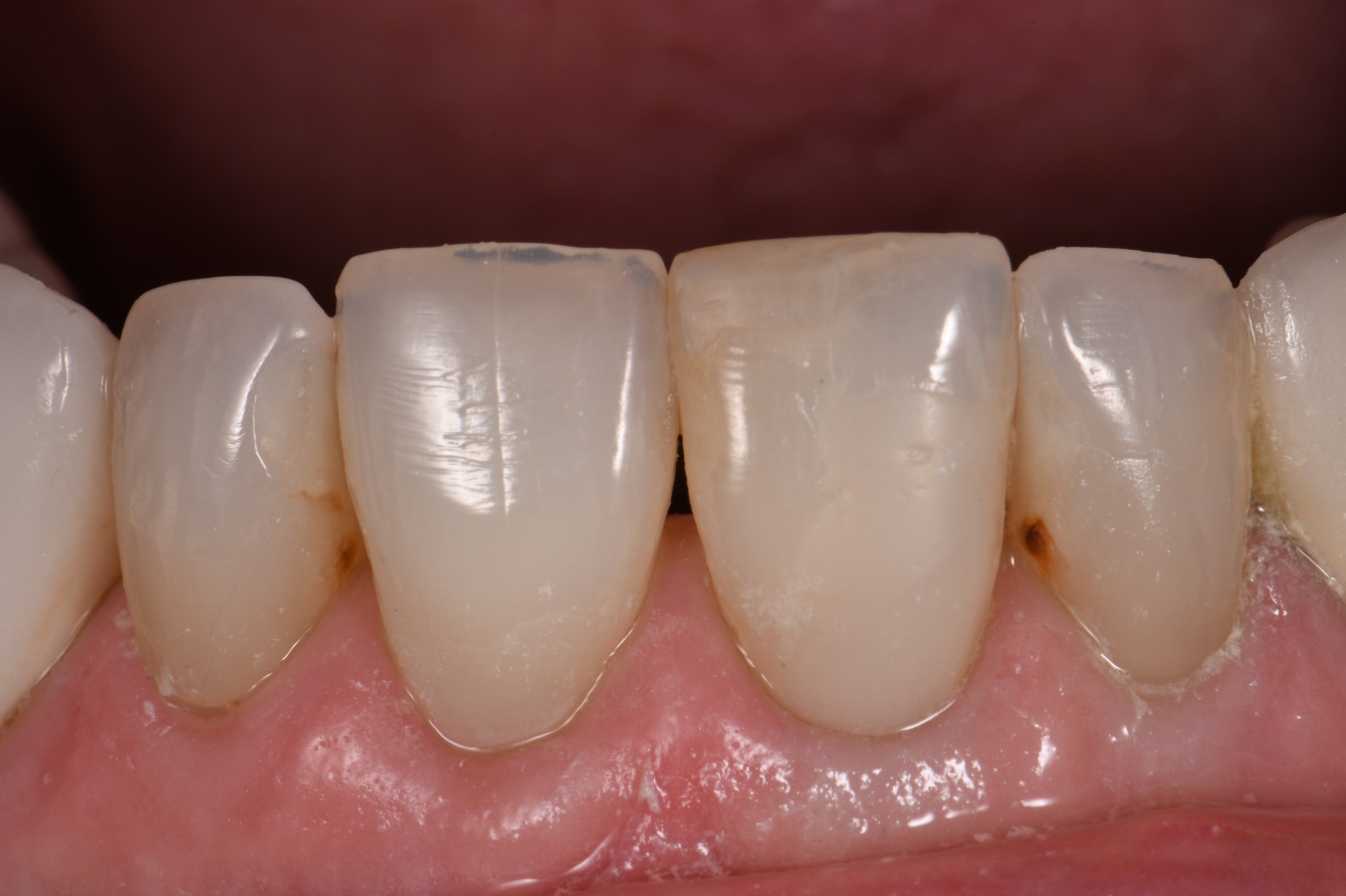 Class V additions in Restorative Dentistry