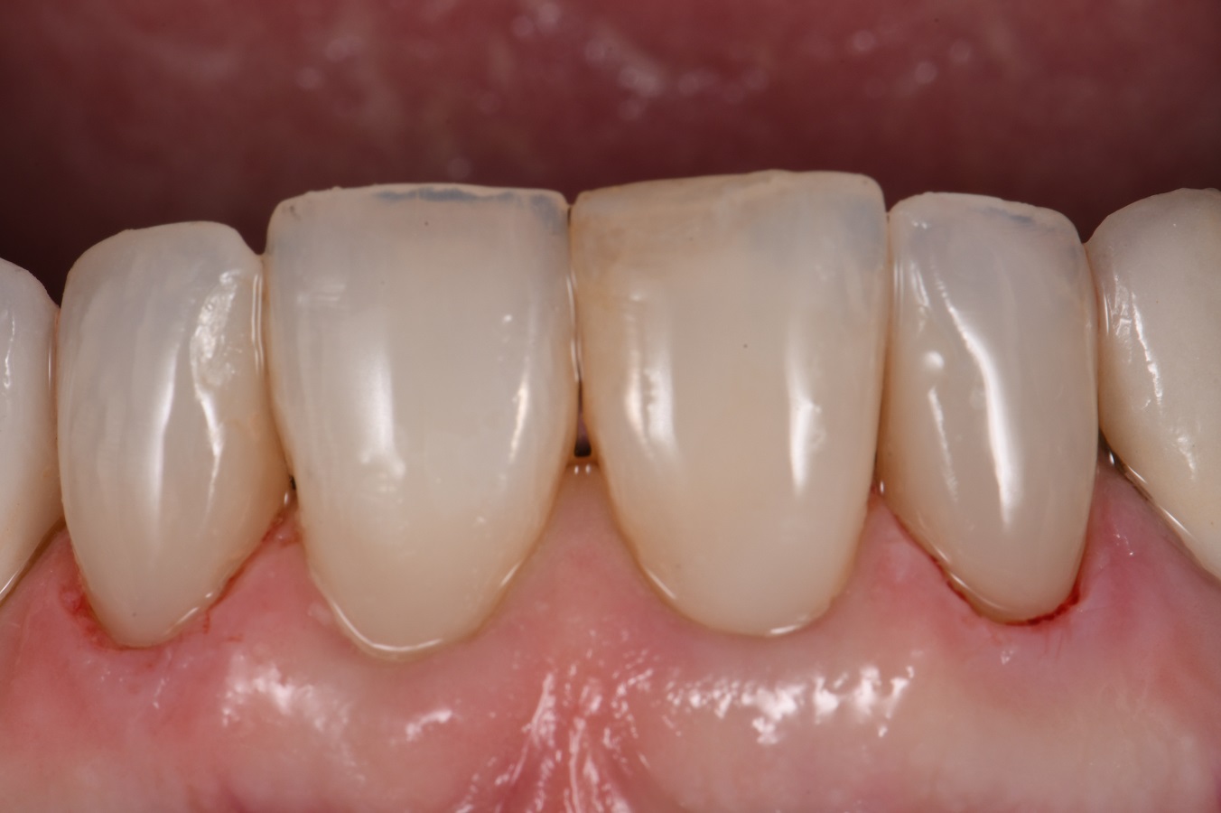 Class V additions in Restorative Dentistry