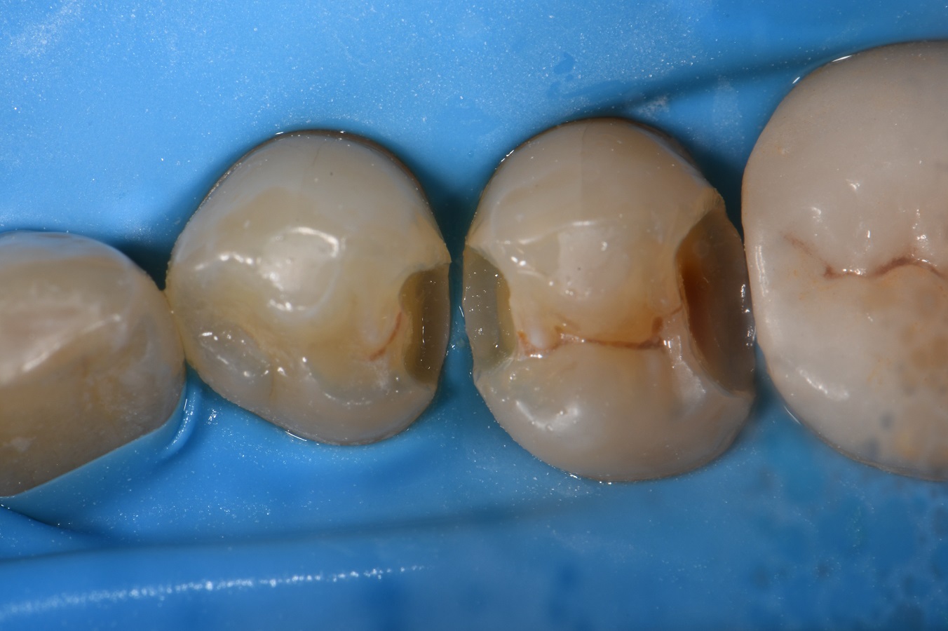 Invisible Class II composite restorations