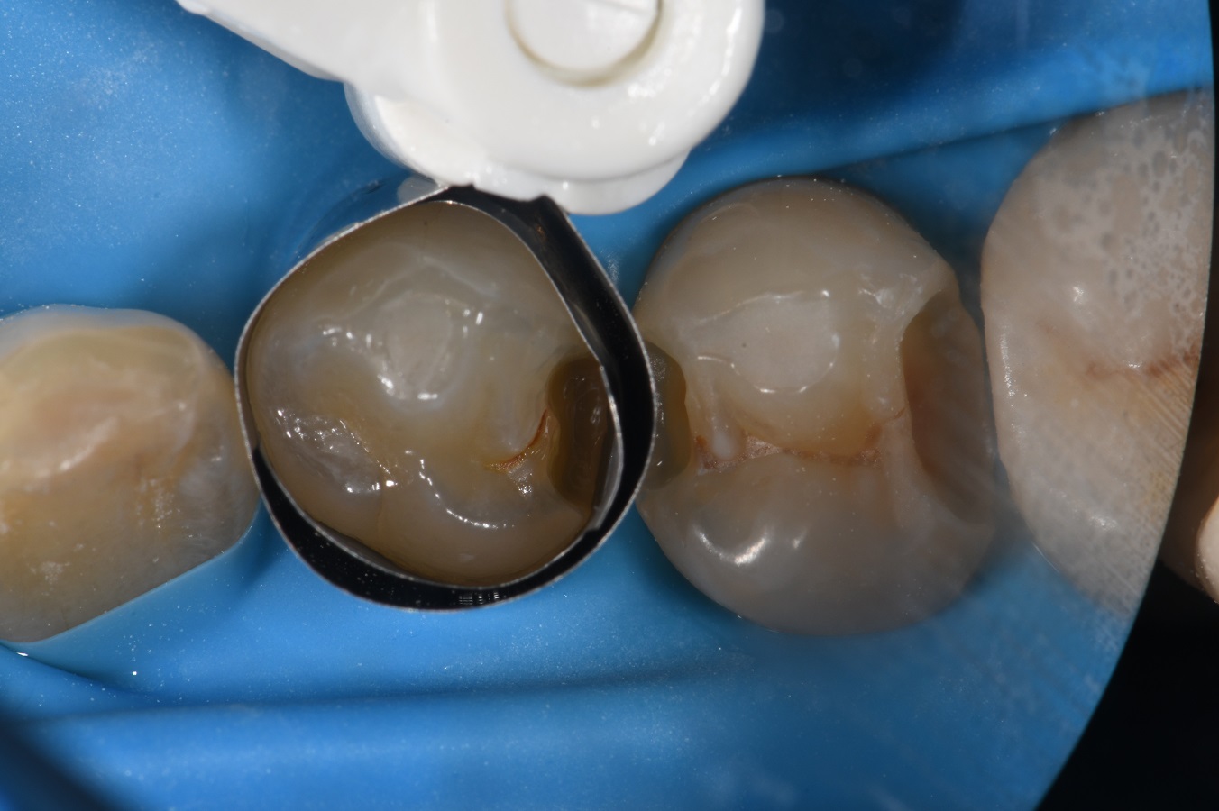 Invisible Class II composite restorations