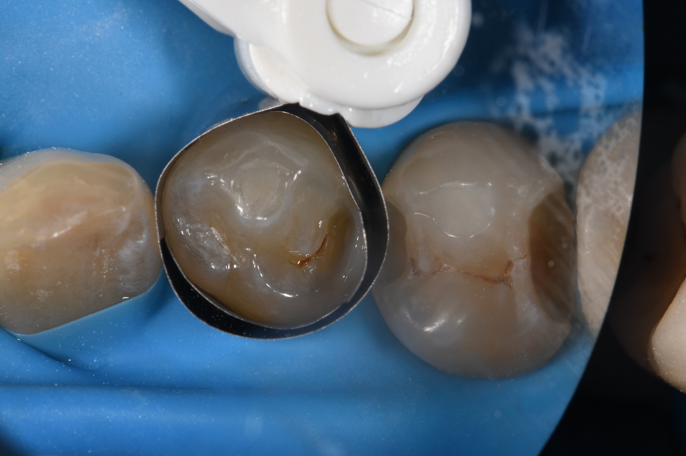 Invisible Class II composite restorations