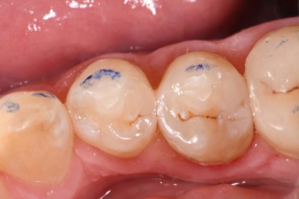 Invisible Class II composite restorations