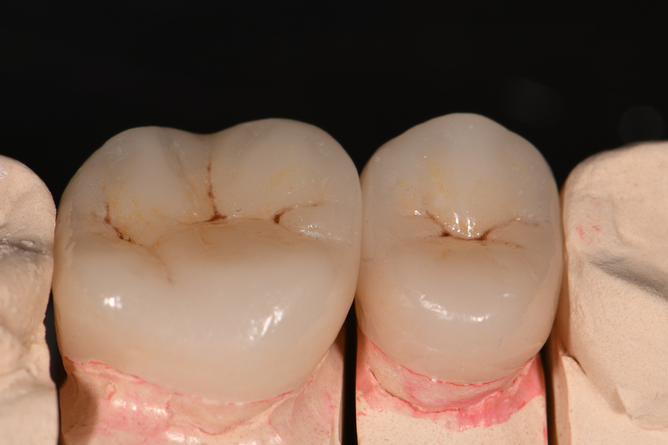 Minimally Invasive Crowns