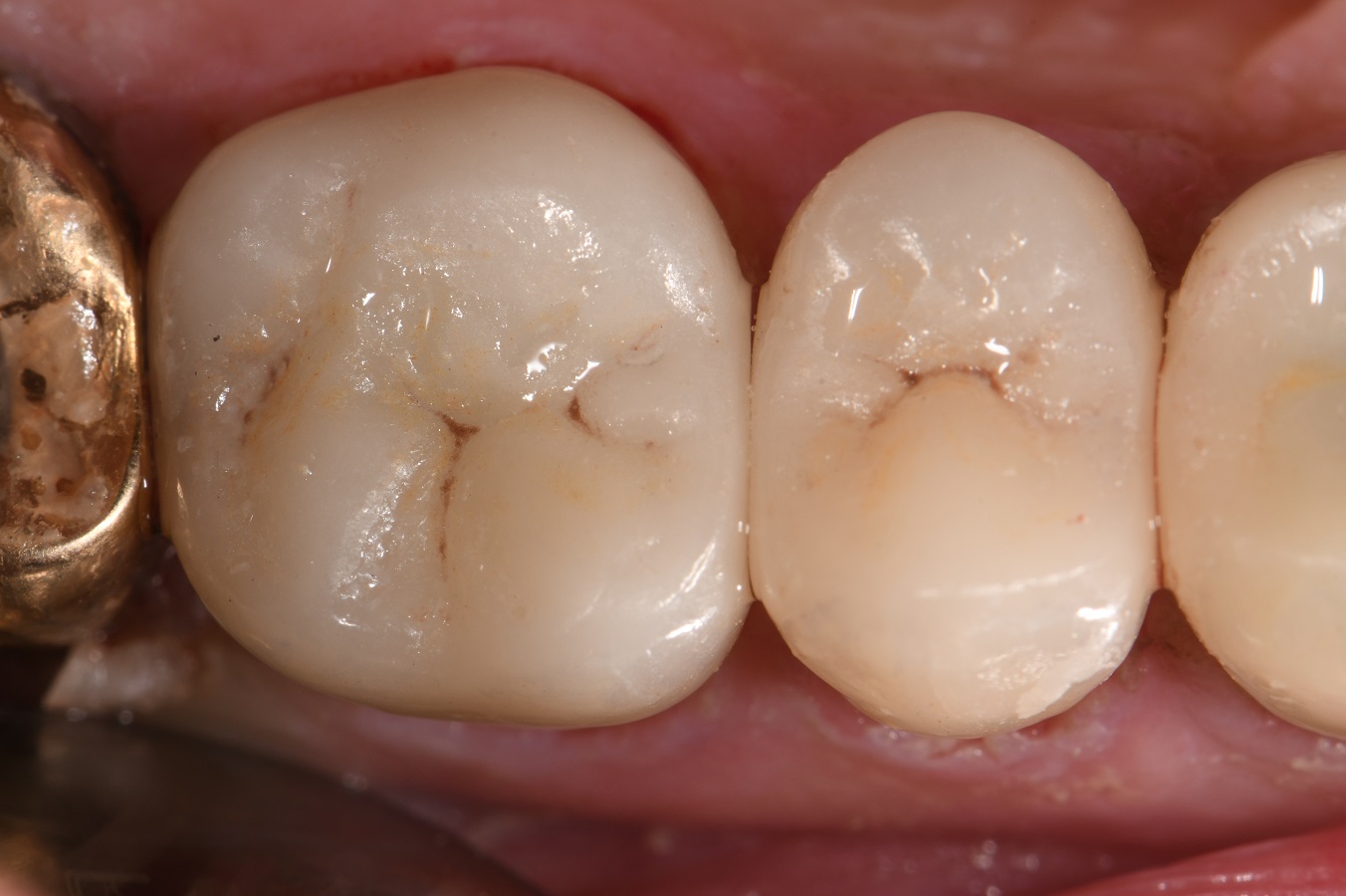 Minimally Invasive Crowns