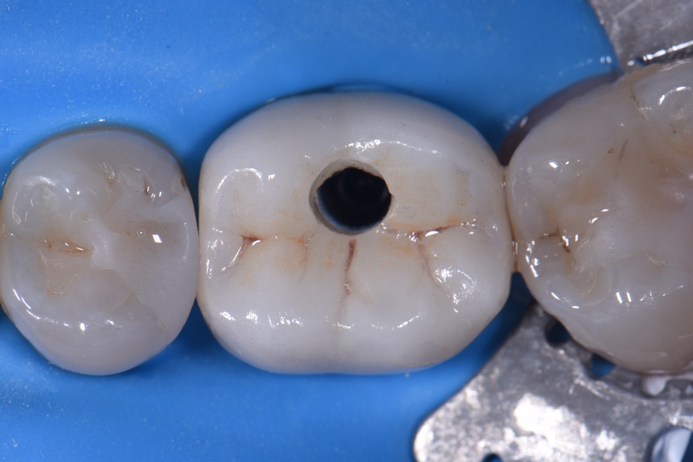 Bonding Screw Channels in Dental Implant Crowns