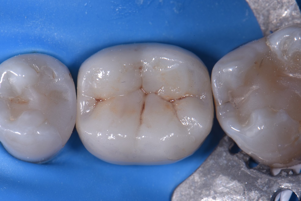 Bonding Screw Channels in Dental Implant Crowns