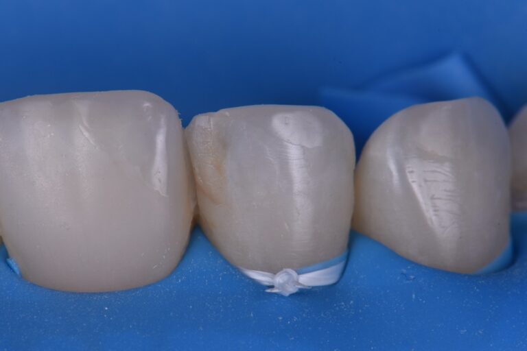 Replacing old composite fillings Replacing old composite fillings