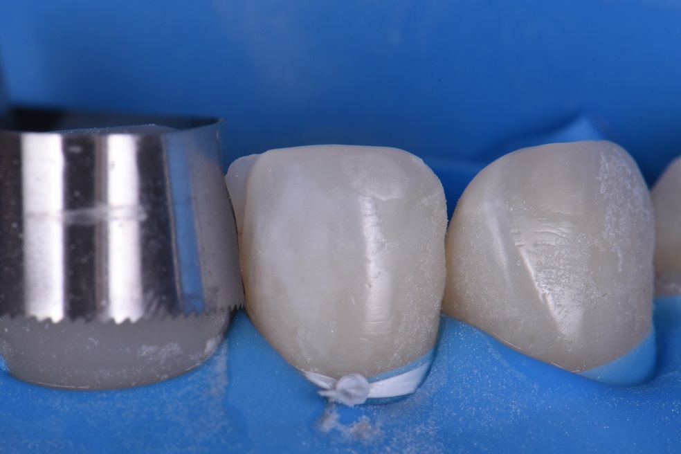 Replacing old composite fillings Replacing old composite fillings