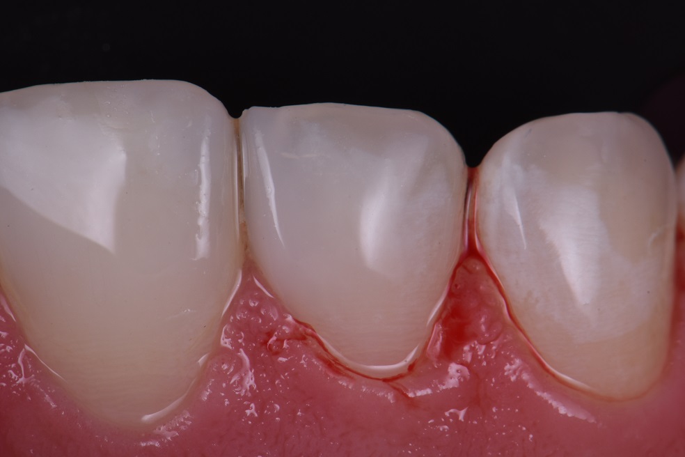 Replacing old composite fillings Replacing old composite fillings