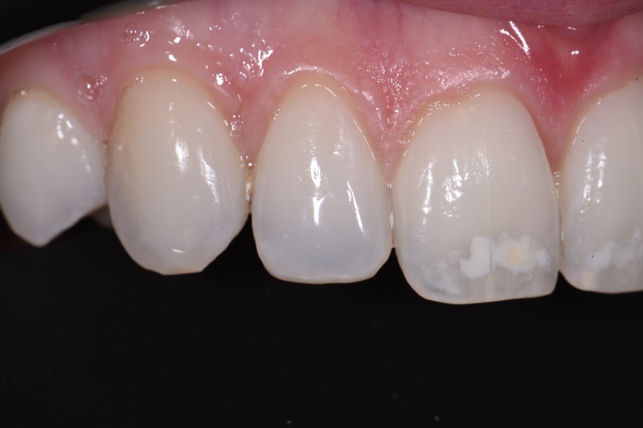 Resin Bonding to Tweak Shapes of Teeth