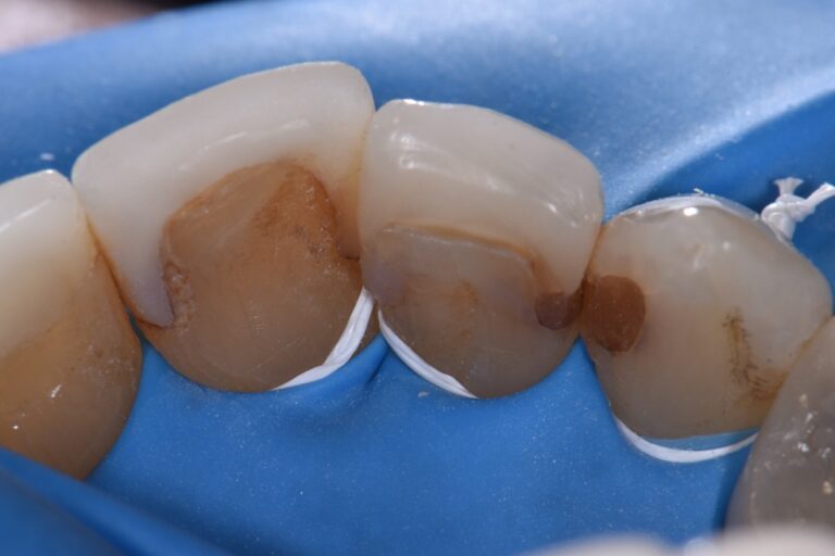 Clean Precise Class III restorations