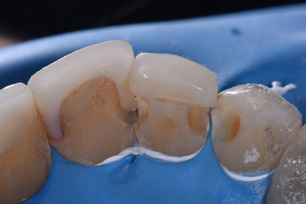 Clean Precise Class III restorations