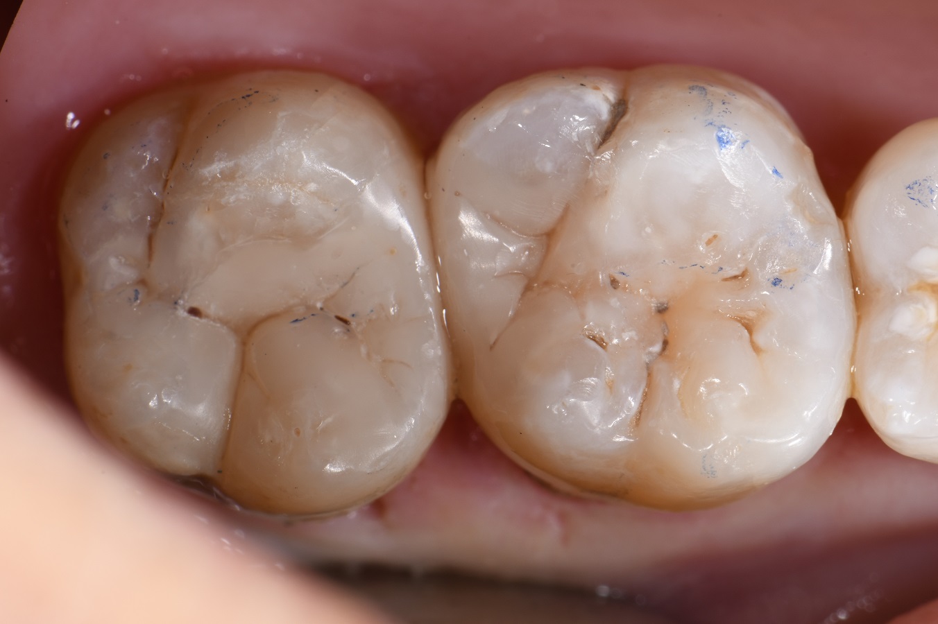 Amalgam Removal and Undetectable Dentistry Amalgam Removal and ...