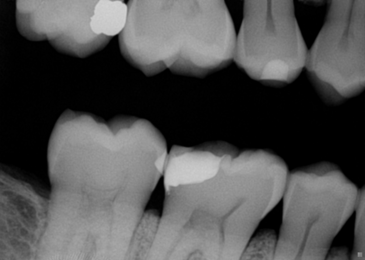Traumatic Fracture of Tooth from Heavy Bite