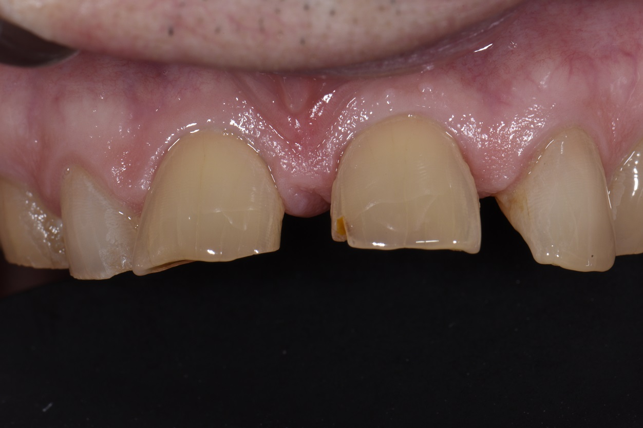 Transitional Bonding | Pre-Prosthetic Orthodontics | Deprogrammer
