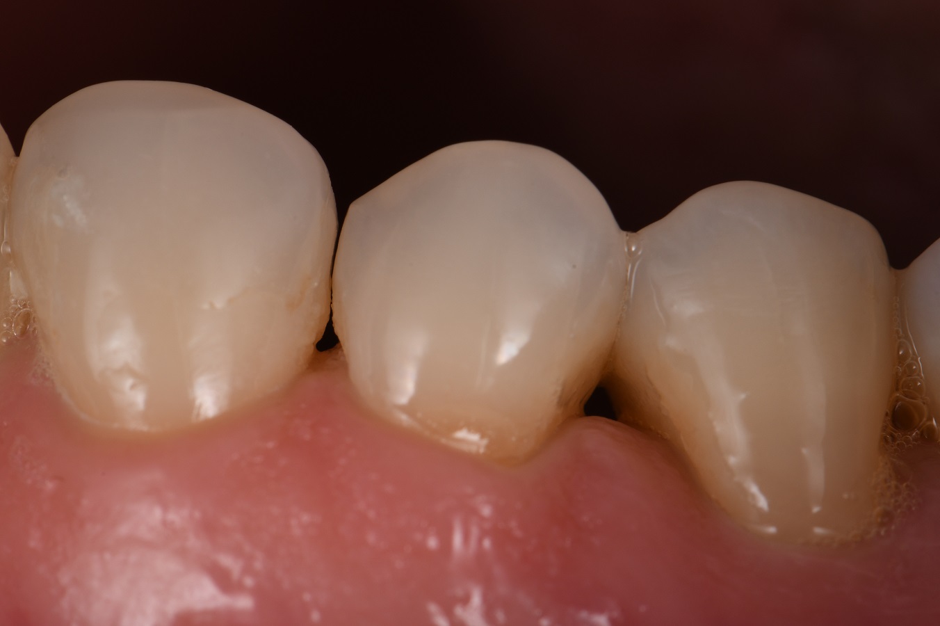 Small Cervical Abrasion Lesions