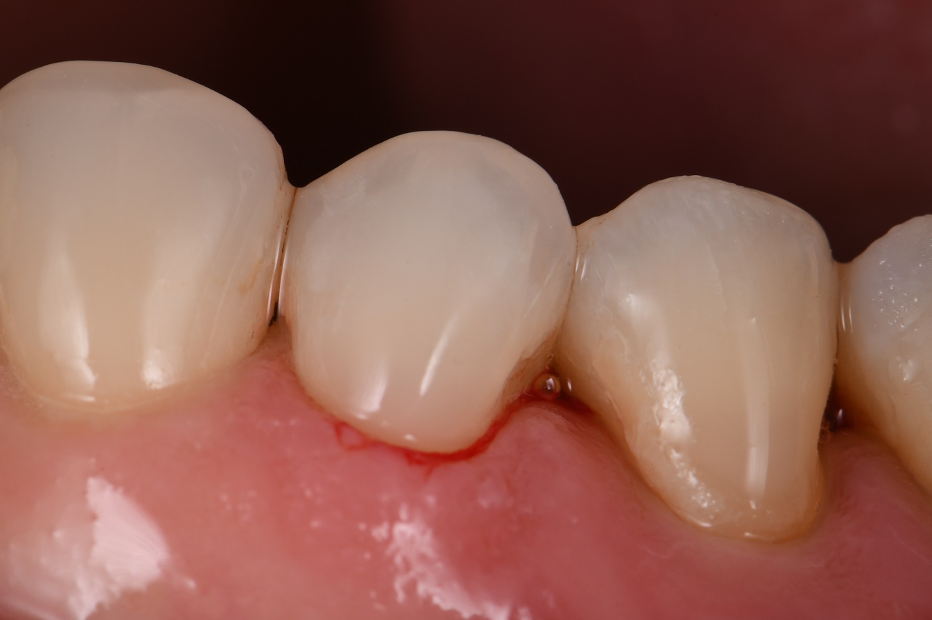 Small Cervical Abrasion Lesions