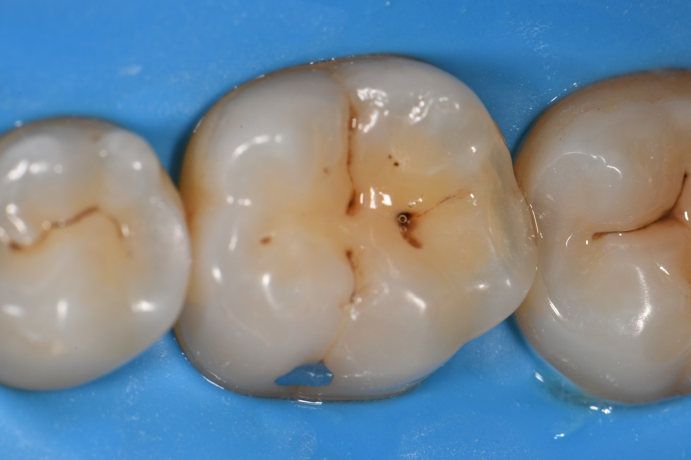 Microdentistry | Composite Restorations Microdentistry | Composite ...