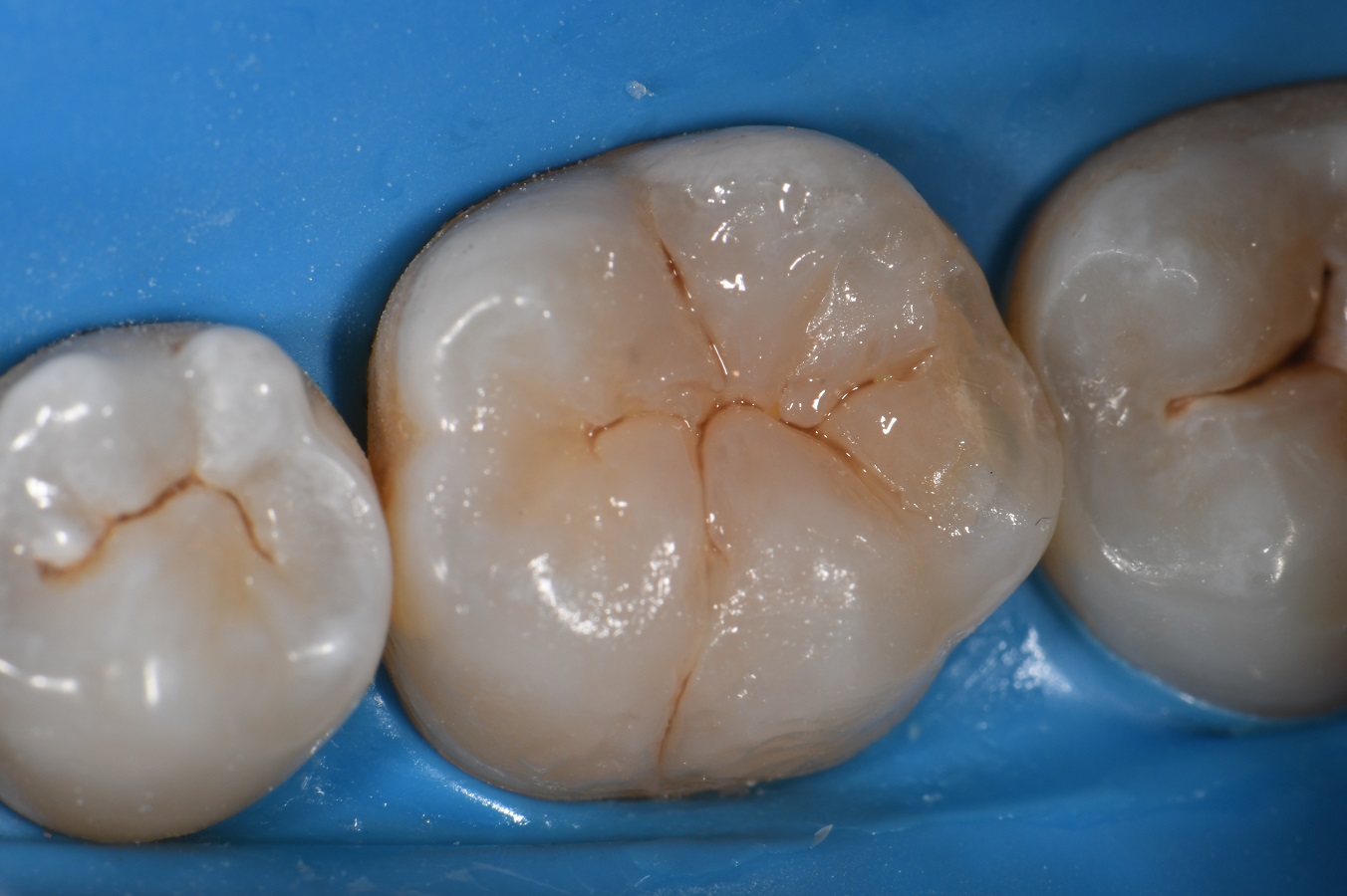 Microdentistry | Composite Restorations Microdentistry | Composite ...