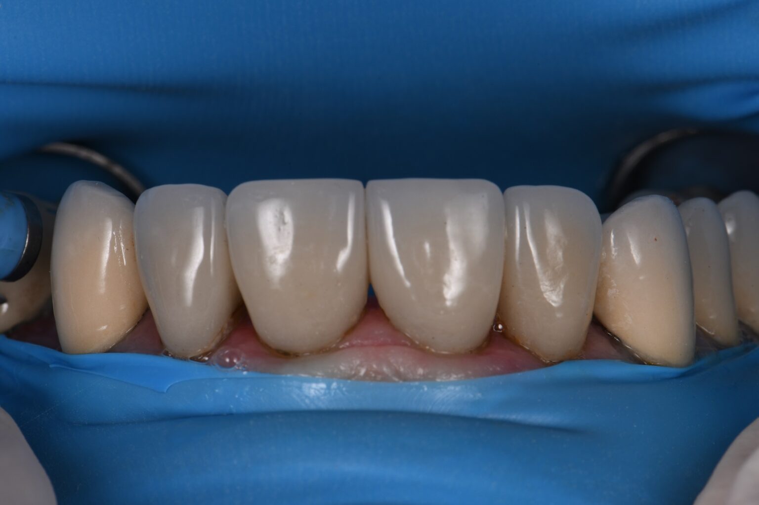 Preparations for New Bonded Porcelain Crowns Preparations for New ...