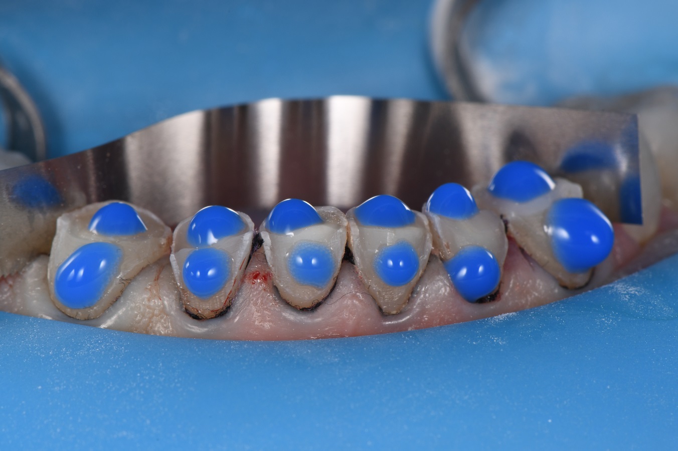 Deprogrammed DSD-guided Transitional Bonding Deprogrammed DSD-guided ...