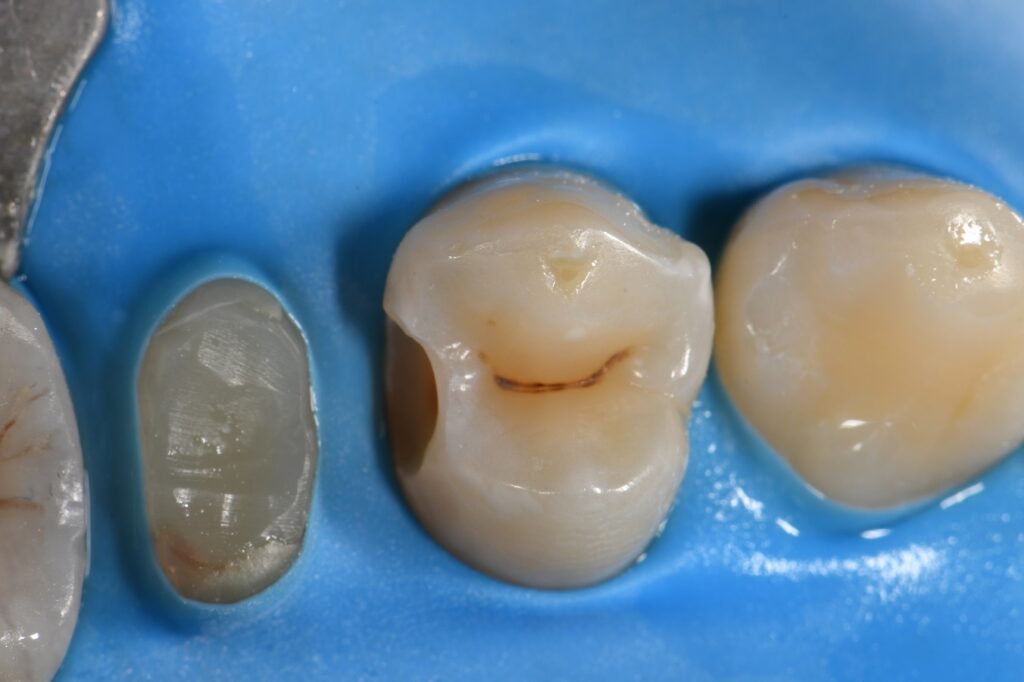 Slot Restoration | Matrix in Matrix Technique Slot Restoration | Matrix ...