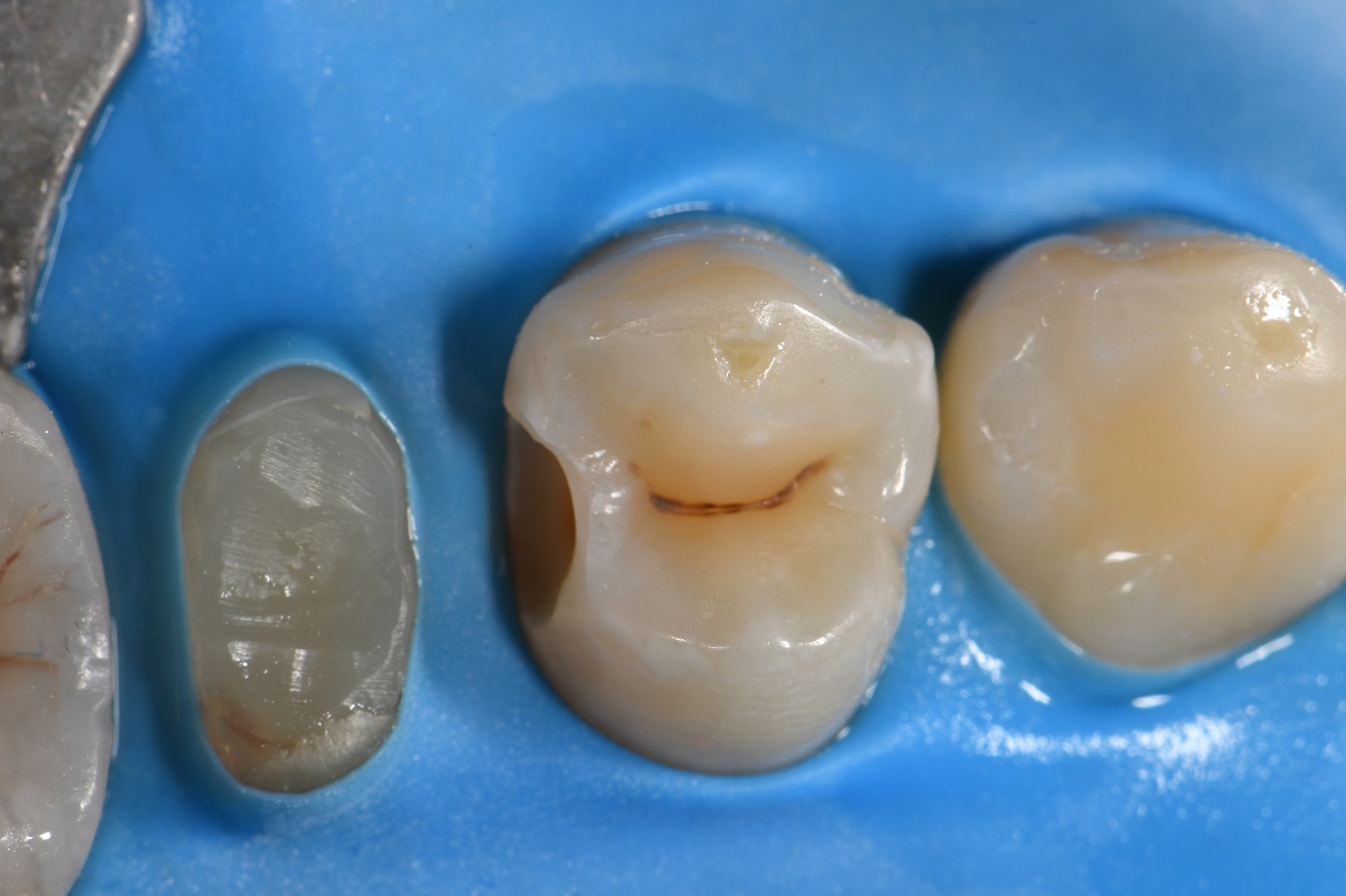 Slot Restoration | Matrix in Matrix Technique Slot Restoration | Matrix ...