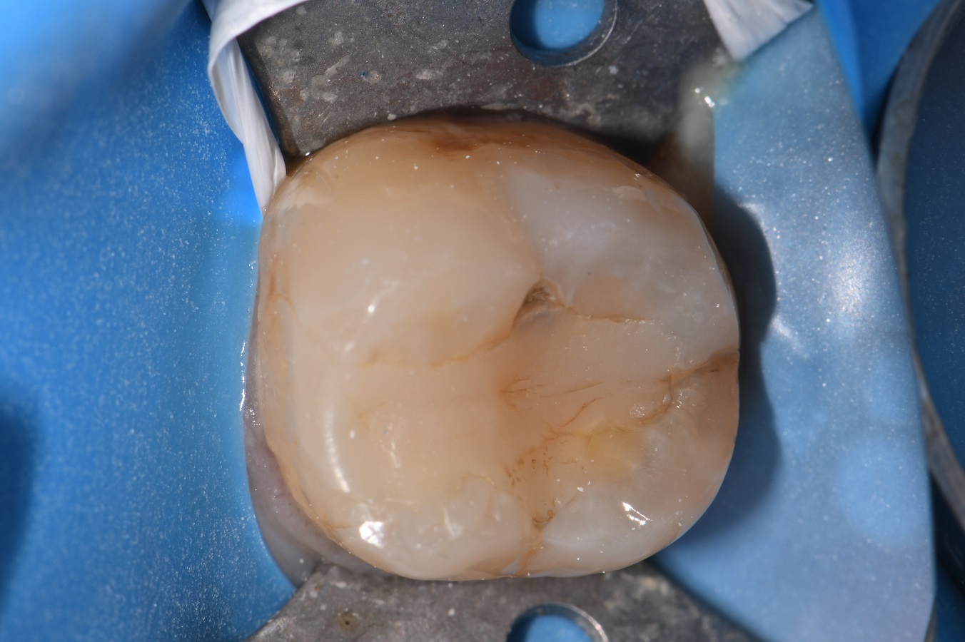 Large Class II restorations Large Class II restorations