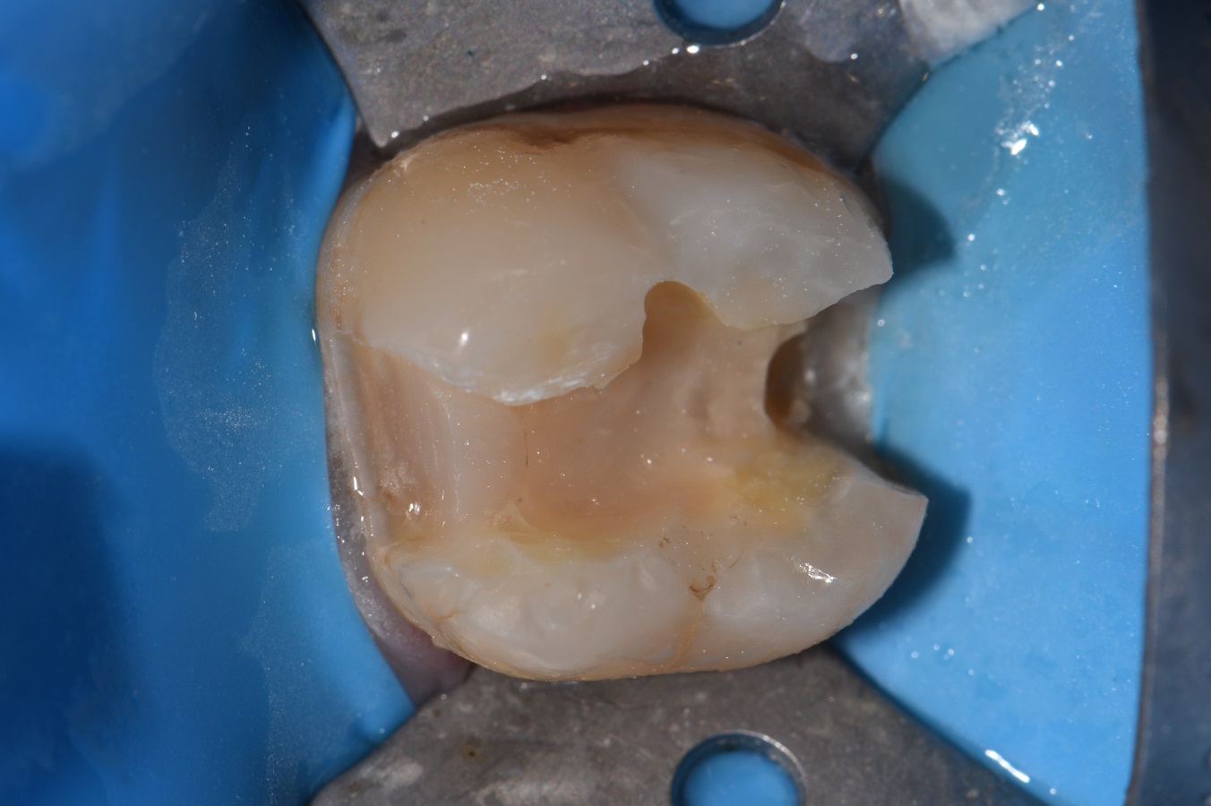 Large Class II restorations Large Class II restorations