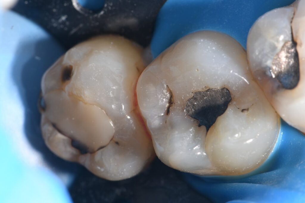 Extensive dental cavities restored Extensive dental cavities restored