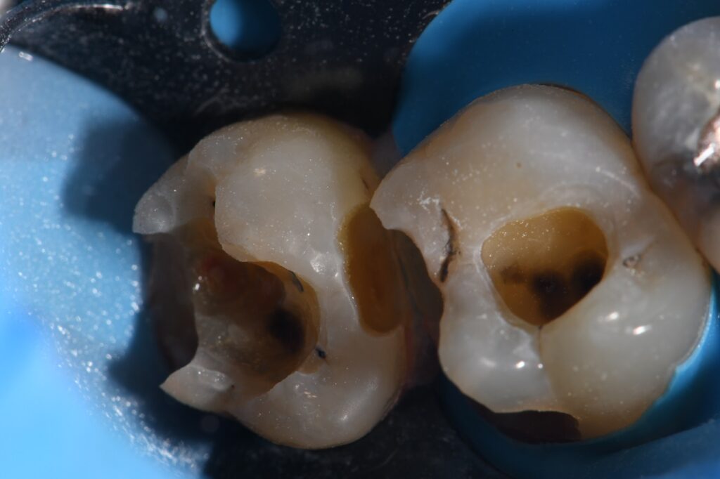 Extensive dental cavities restored Extensive dental cavities restored