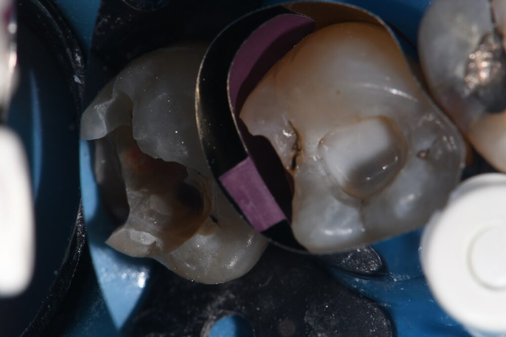 Extensive dental cavities restored Extensive dental cavities restored