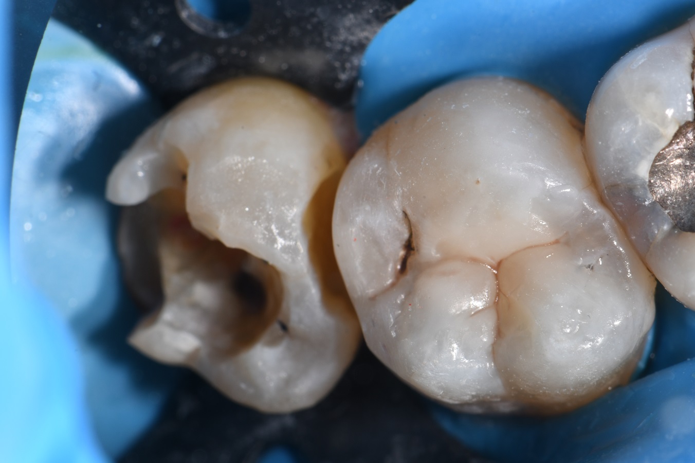 Extensive dental cavities restored Extensive dental cavities restored