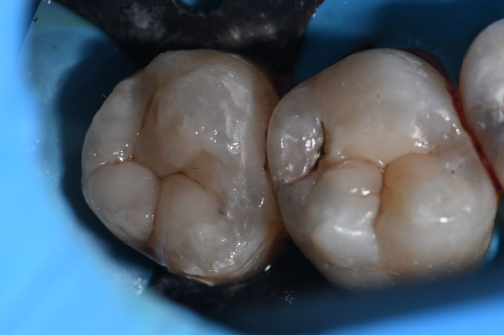 Extensive dental cavities restored Extensive dental cavities restored