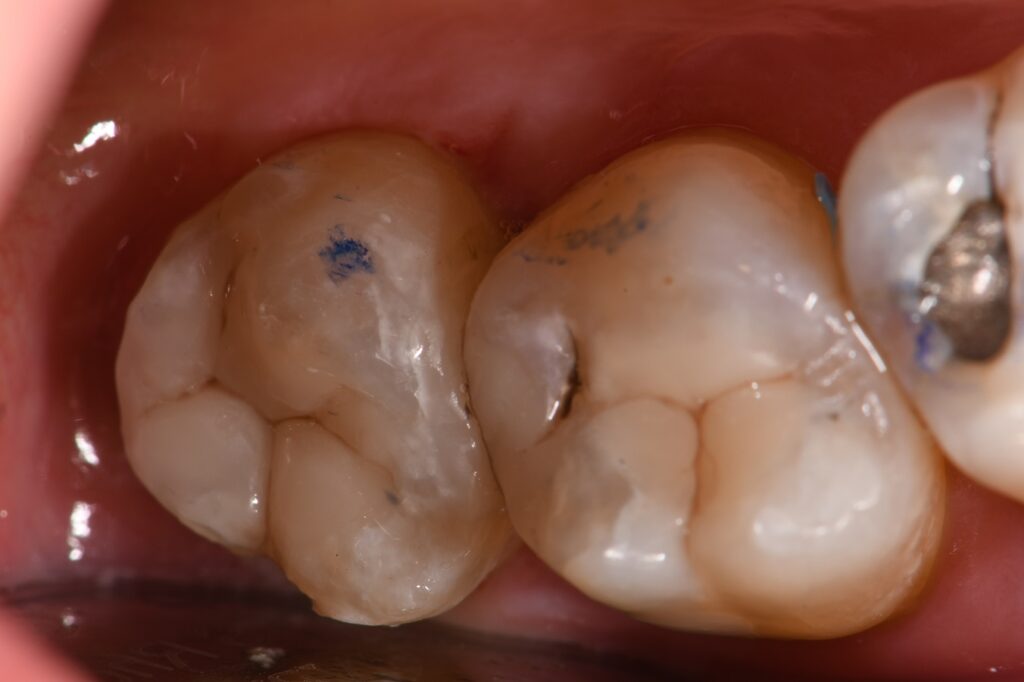 Extensive dental cavities restored Extensive dental cavities restored