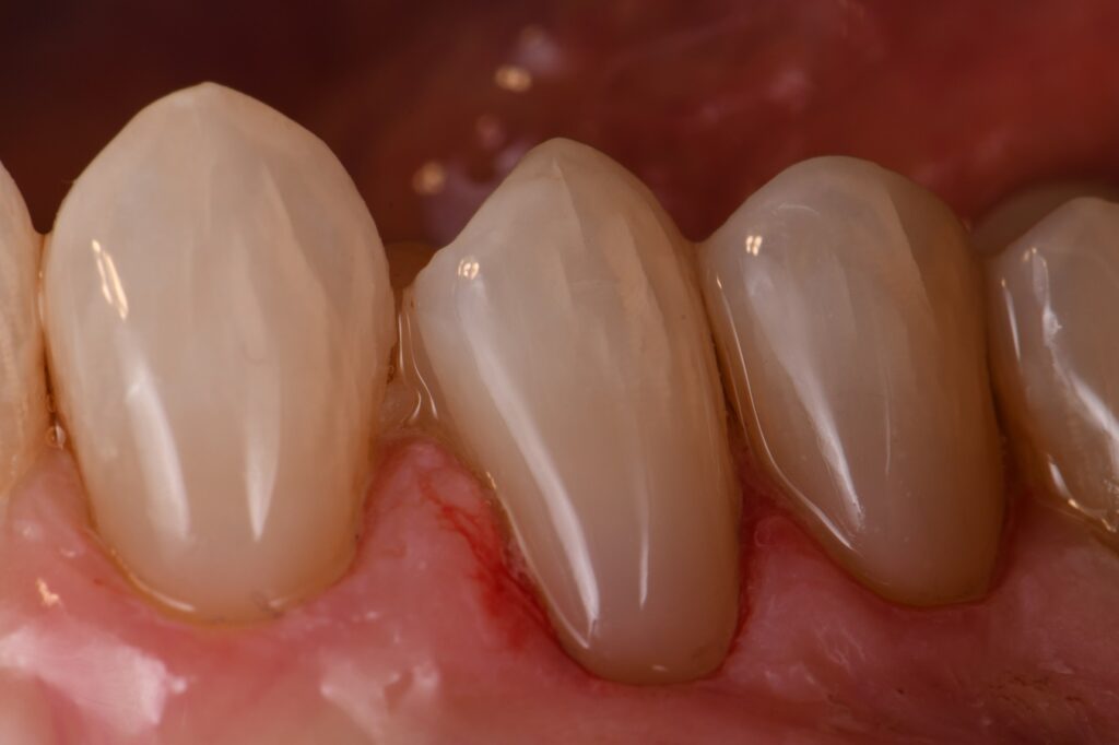 Beautiful Composite Restorations Beautiful Composite Restorations